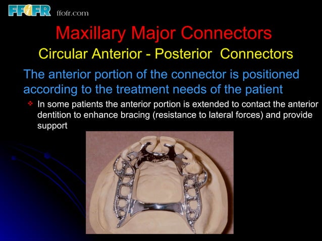 4.the tooth tissue junction, major and minor connectors | PPT | Dental ...