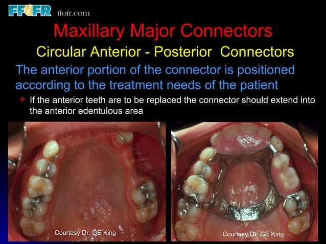 4.the tooth tissue junction, major and minor connectors | PPT | Dental ...