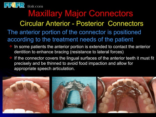 4.the tooth tissue junction, major and minor connectors | PPT | Dental ...