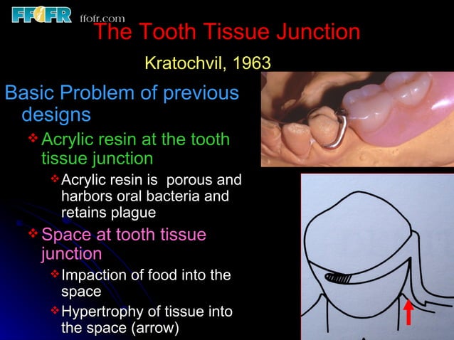 4.the tooth tissue junction, major and minor connectors | PPT | Dental ...
