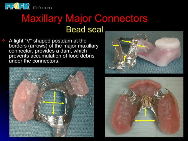 4.the tooth tissue junction, major and minor connectors | PPT | Dental ...
