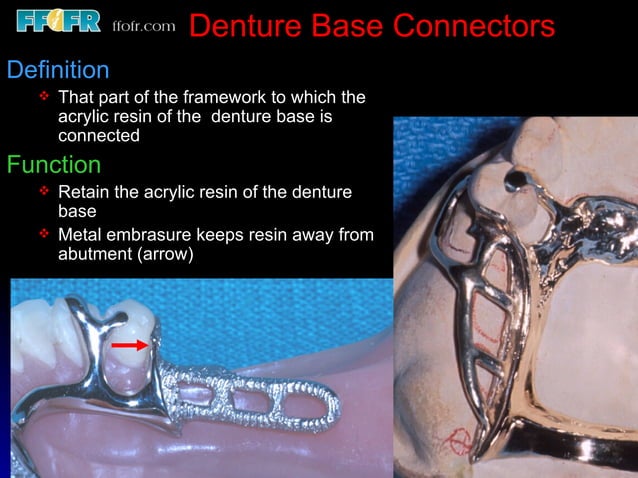 4.the tooth tissue junction, major and minor connectors | PPT | Dental ...