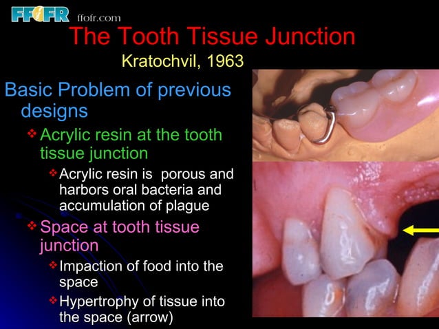 4.the tooth tissue junction, major and minor connectors | PPT | Dental ...