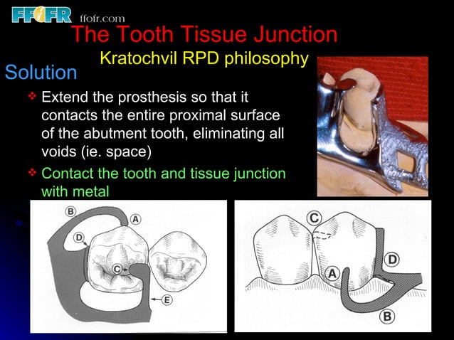 4.the tooth tissue junction, major and minor connectors | PPT | Dental ...