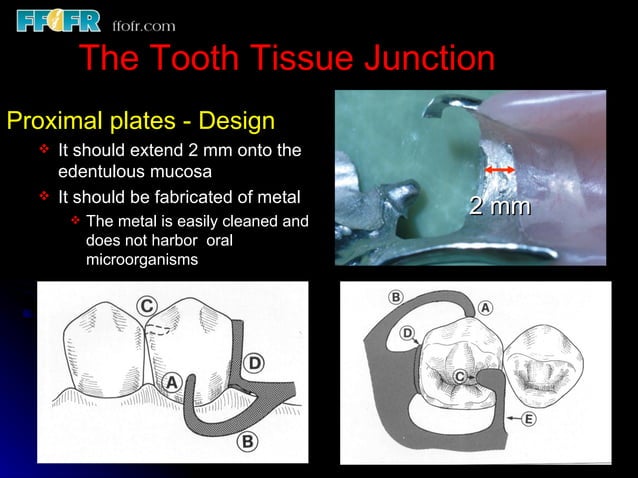 4.the tooth tissue junction, major and minor connectors | PPT | Dental ...
