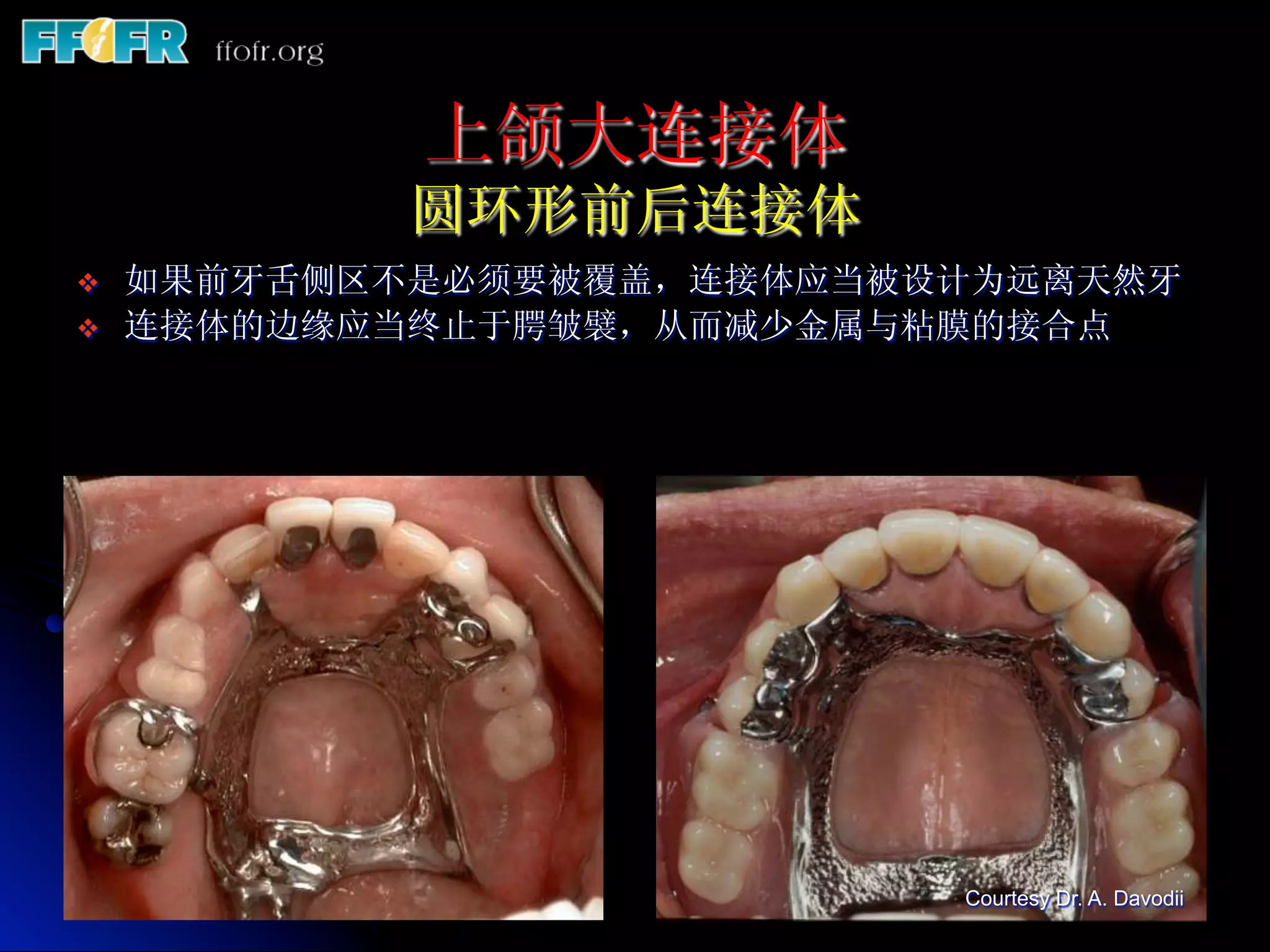 4.the tooth tissue junction, major and minor connectors | PPT