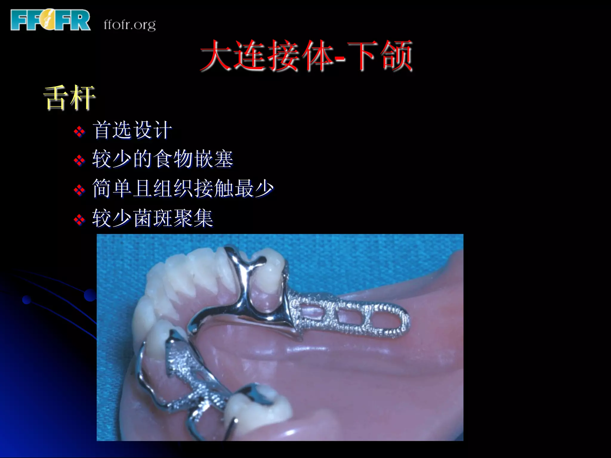 4.the tooth tissue junction, major and minor connectors | PPT