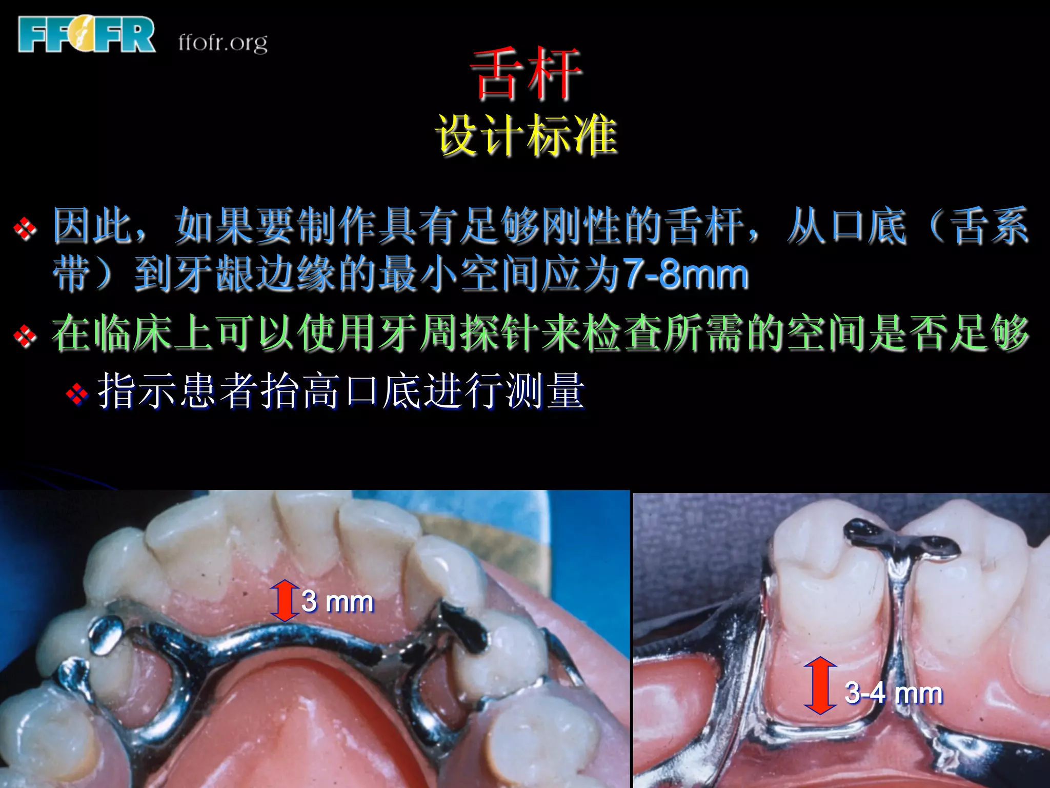 4.the tooth tissue junction, major and minor connectors | PPT