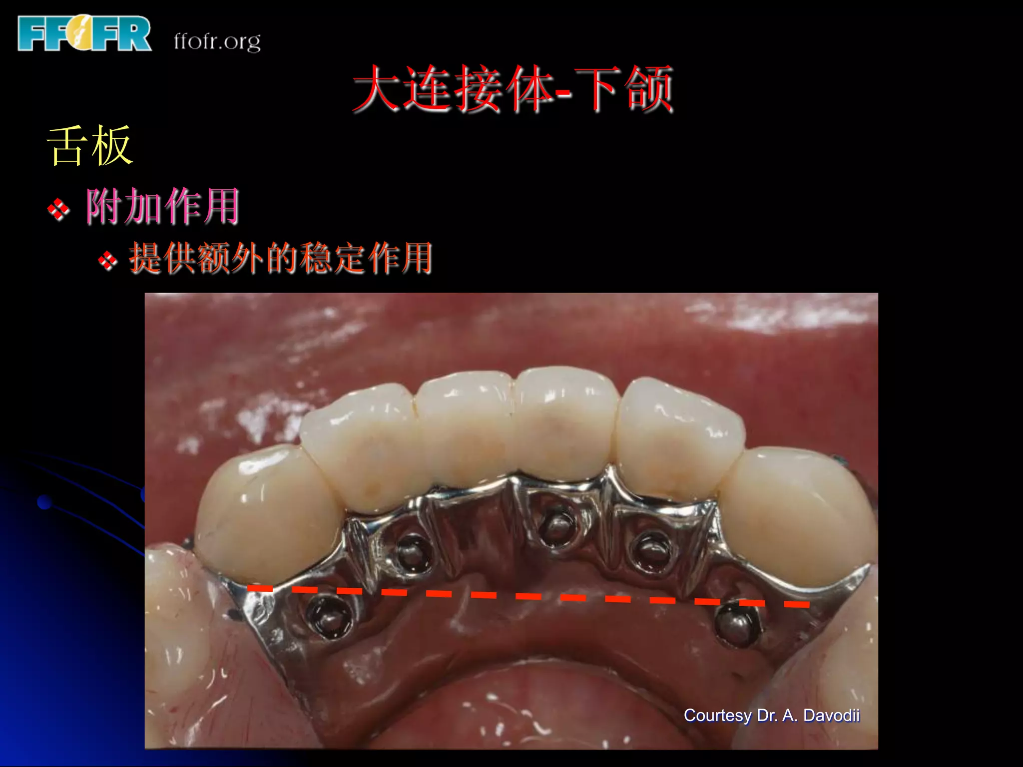 4.the tooth tissue junction, major and minor connectors | PPT