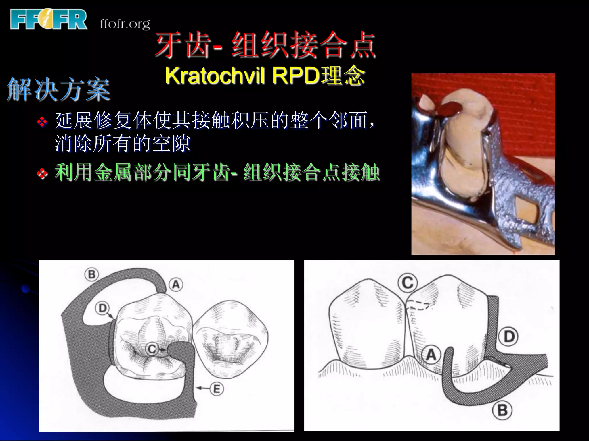 4.the tooth tissue junction, major and minor connectors | PPT