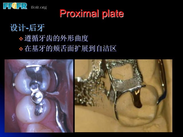 4.the tooth tissue junction, major and minor connectors | PPT