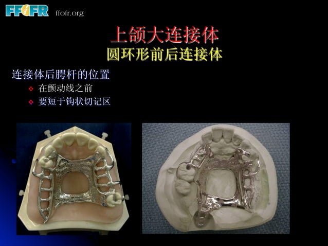 4.the tooth tissue junction, major and minor connectors | PPT