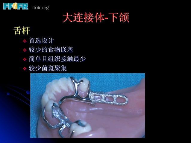 4.the tooth tissue junction, major and minor connectors | PPT