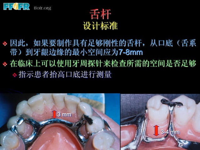 4.the tooth tissue junction, major and minor connectors | PPT
