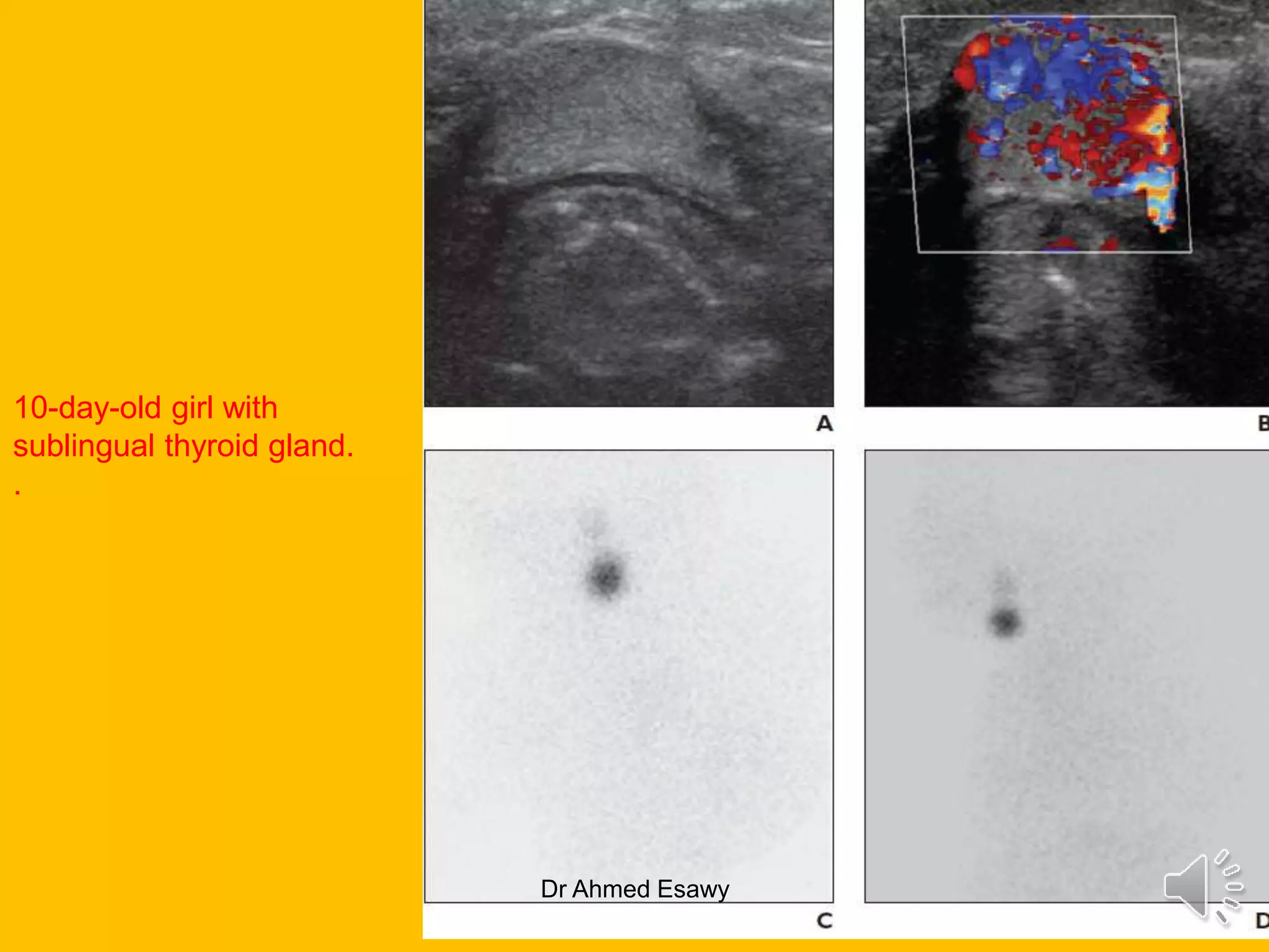thyriod gland HYPOTHYRIODISM imaging part 4 (hypothyriodism) Dr Ahmed ...