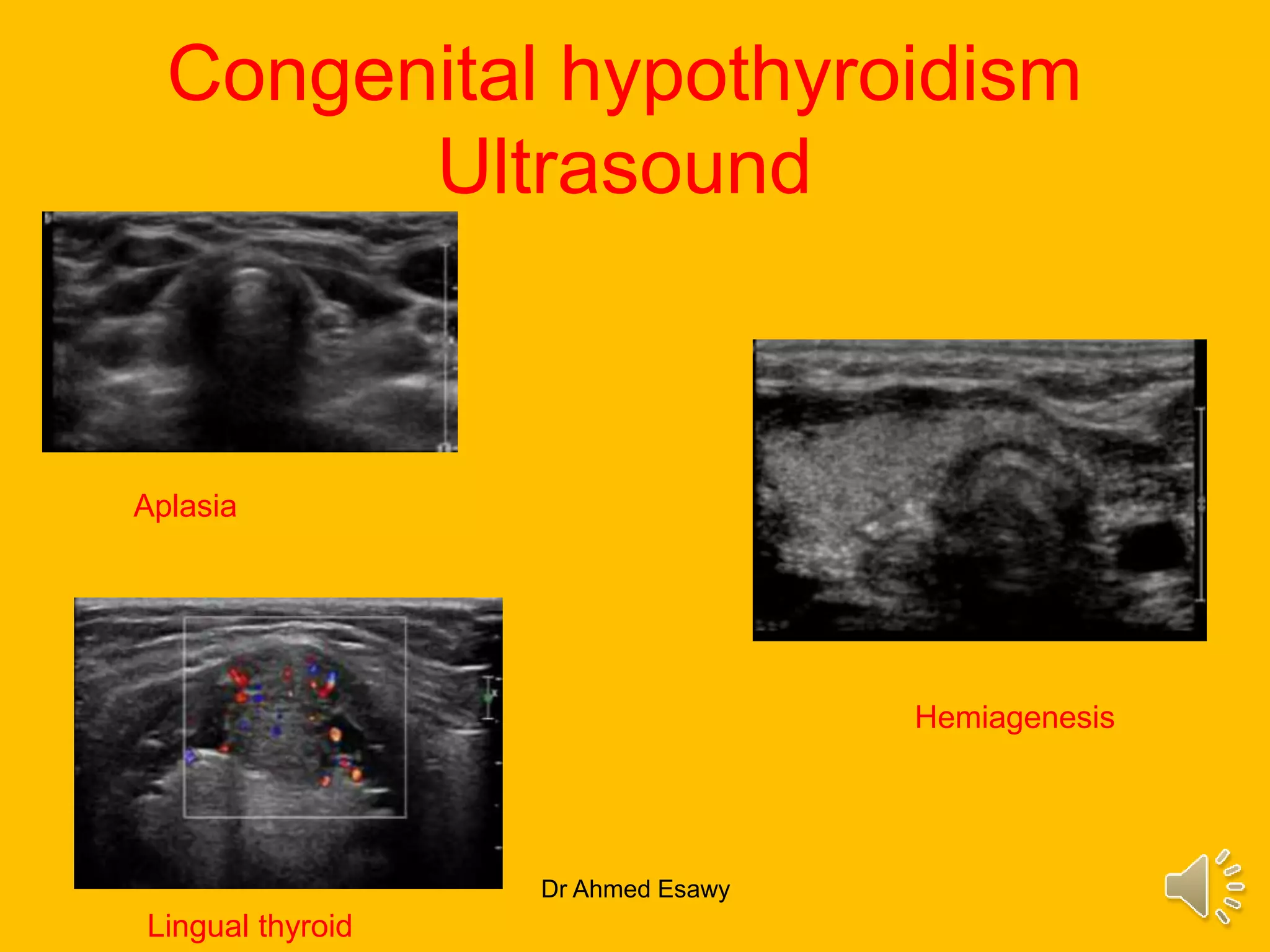 thyriod gland HYPOTHYRIODISM imaging part 4 (hypothyriodism) Dr Ahmed ...