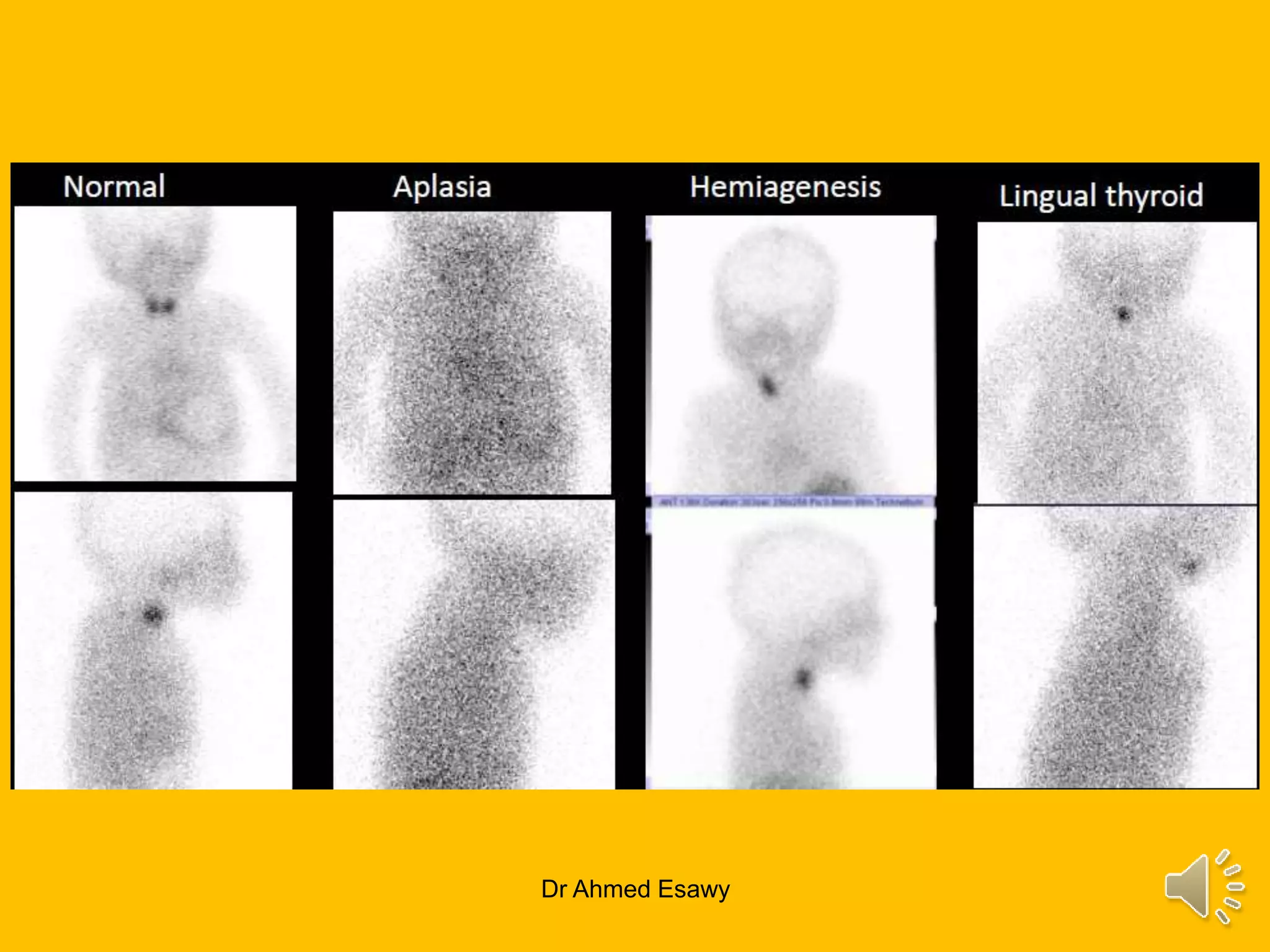 thyriod gland HYPOTHYRIODISM imaging part 4 (hypothyriodism) Dr Ahmed ...