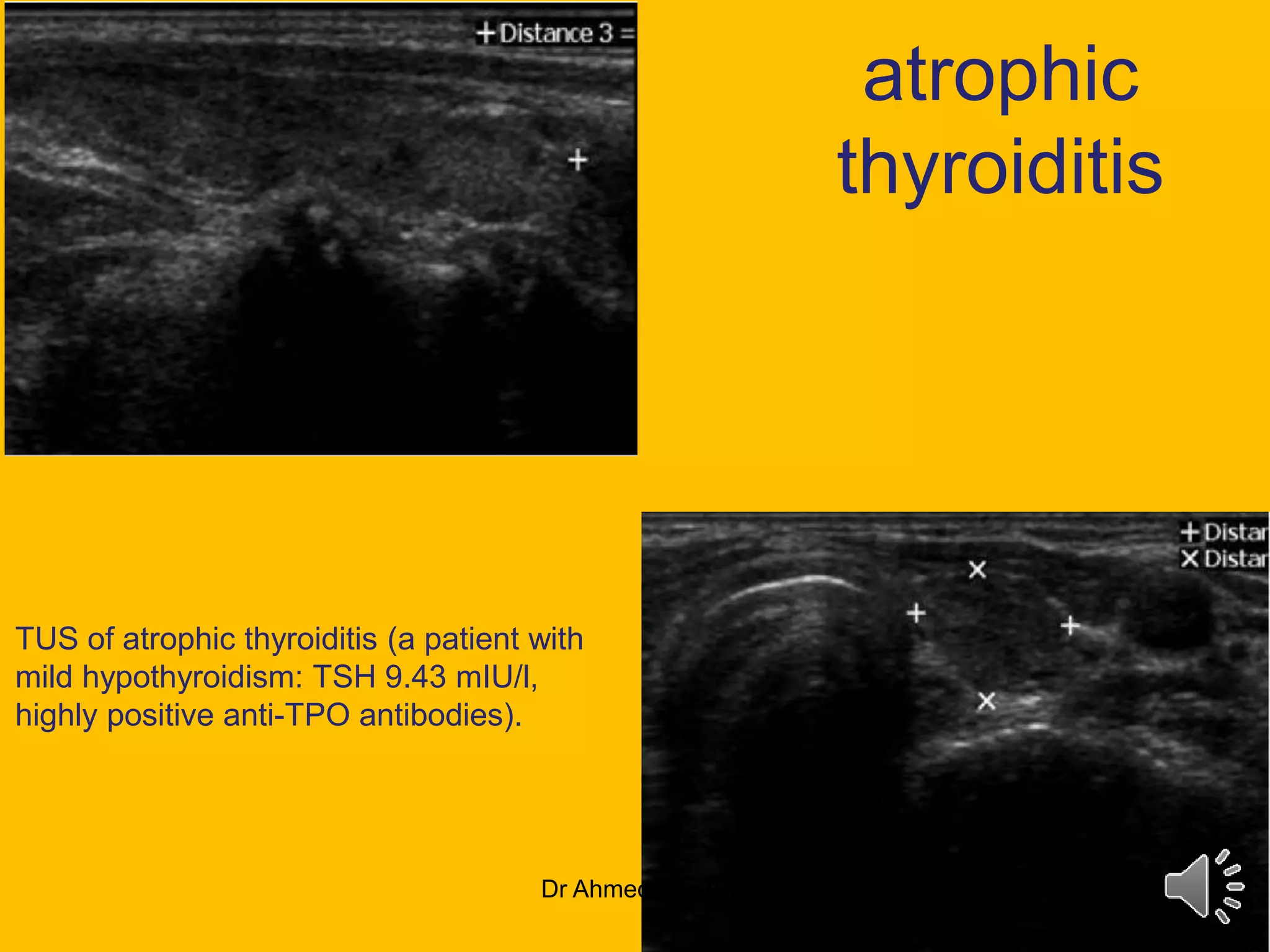thyriod gland HYPOTHYRIODISM imaging part 4 (hypothyriodism) Dr Ahmed ...
