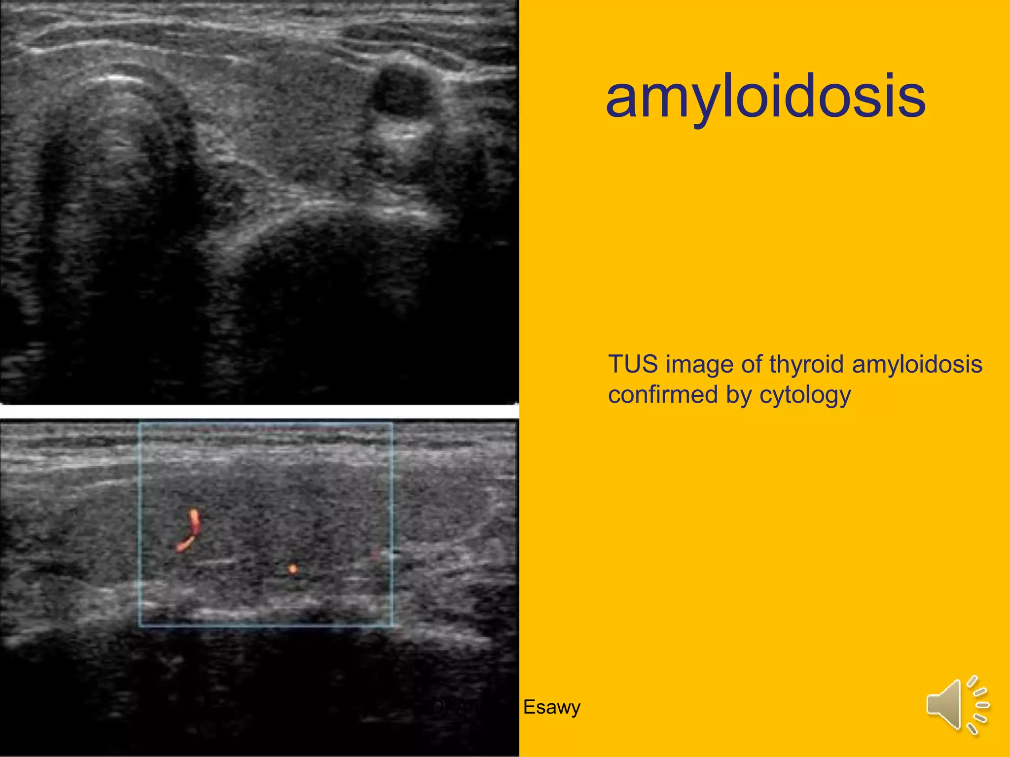 thyriod gland HYPOTHYRIODISM imaging part 4 (hypothyriodism) Dr Ahmed ...