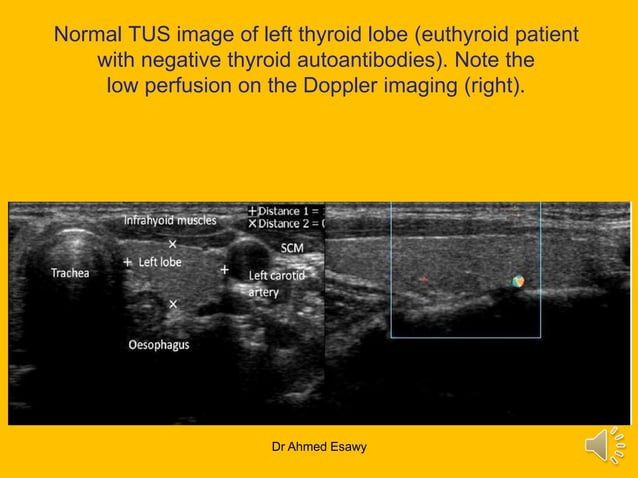 thyriod gland HYPOTHYRIODISM imaging part 4 (hypothyriodism) Dr Ahmed ...