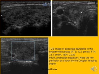 thyriod gland HYPOTHYRIODISM imaging part 4 (hypothyriodism) Dr Ahmed ...