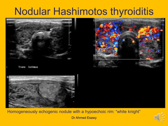 thyriod gland HYPOTHYRIODISM imaging part 4 (hypothyriodism) Dr Ahmed ...