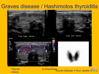 Graves Disease Thyroid Ultrasound