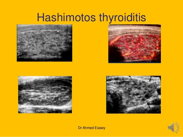 thyriod gland HYPOTHYRIODISM imaging part 4 (hypothyriodism) Dr Ahmed…