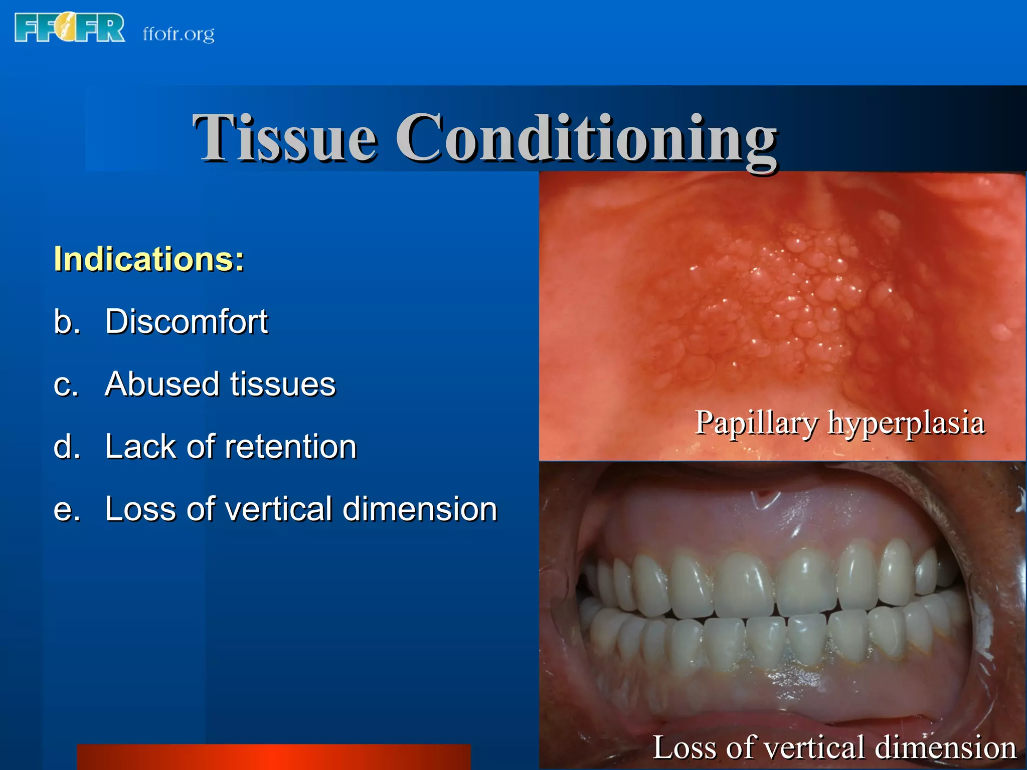 4.tissue conditioning | PPT