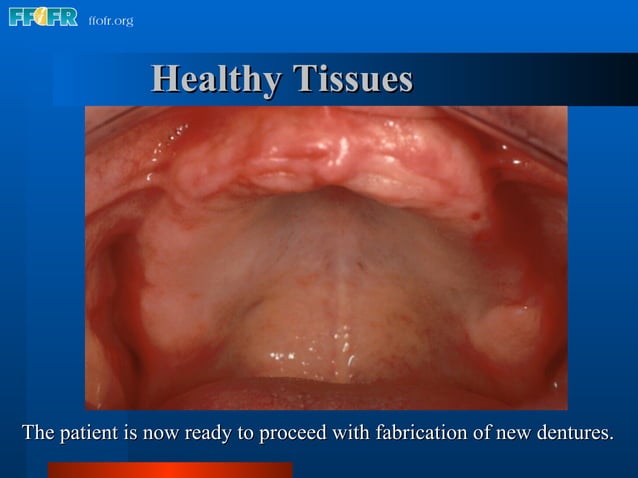 4.tissue conditioning | PPT