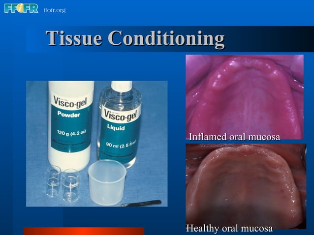 4.tissue conditioning | PPT