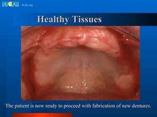 4.tissue conditioning | PPT