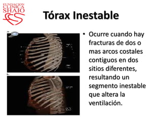 4 Trauma torácico, Alexandra Joya | PPTX