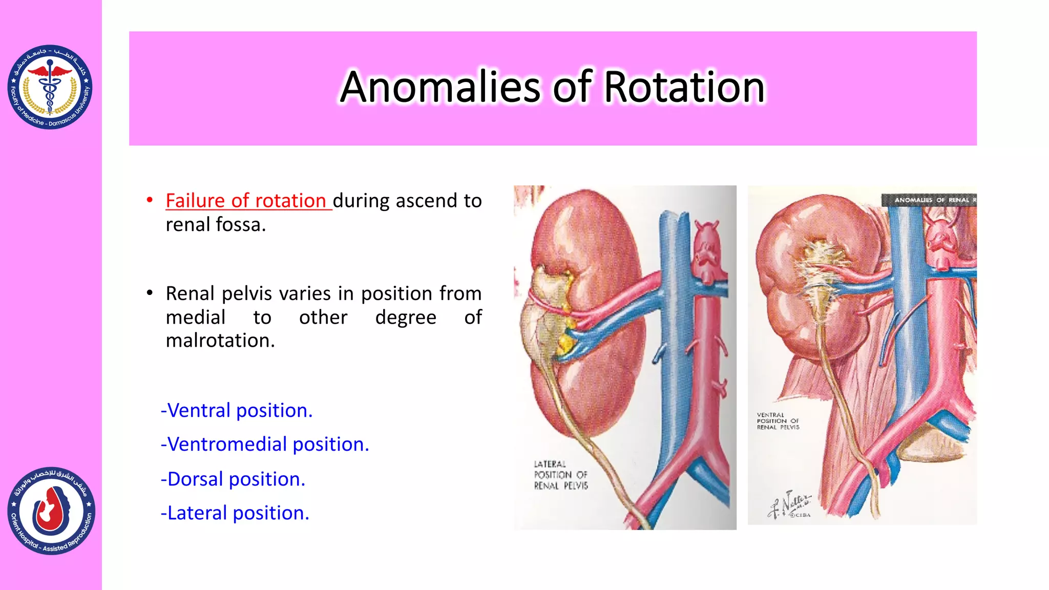 Urinary system anomalies | PDF