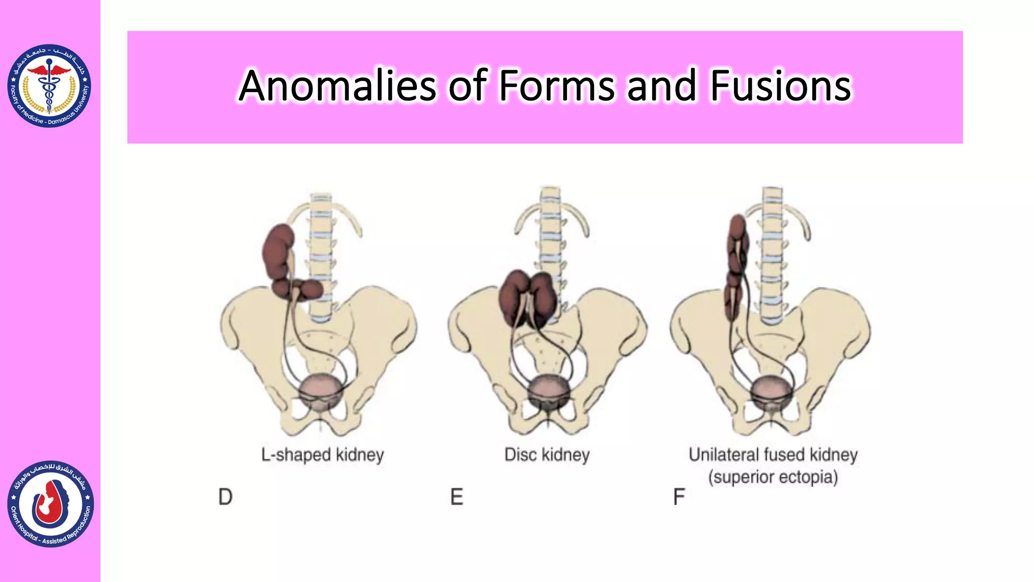Urinary system anomalies | PDF