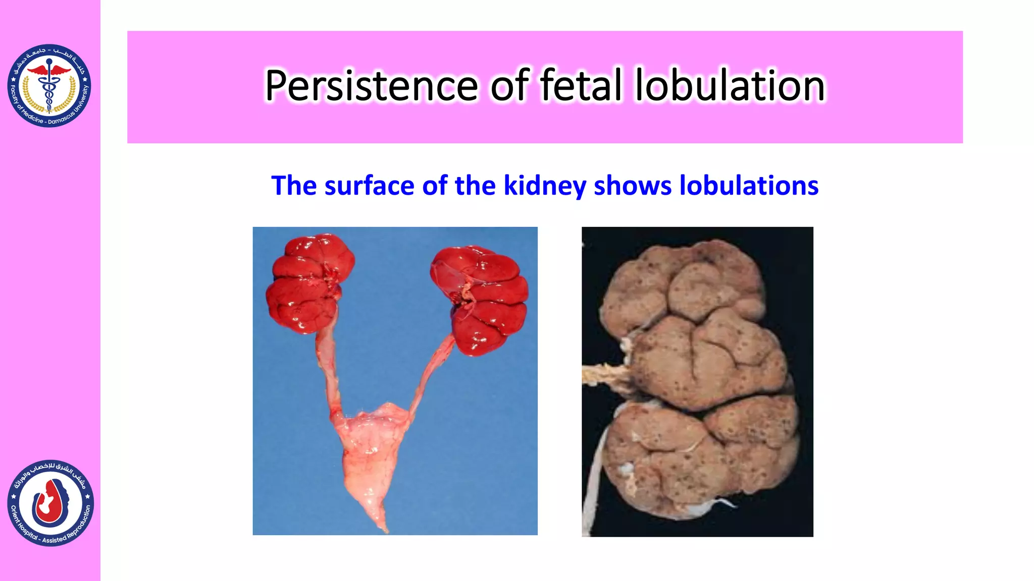 Urinary system anomalies | PDF