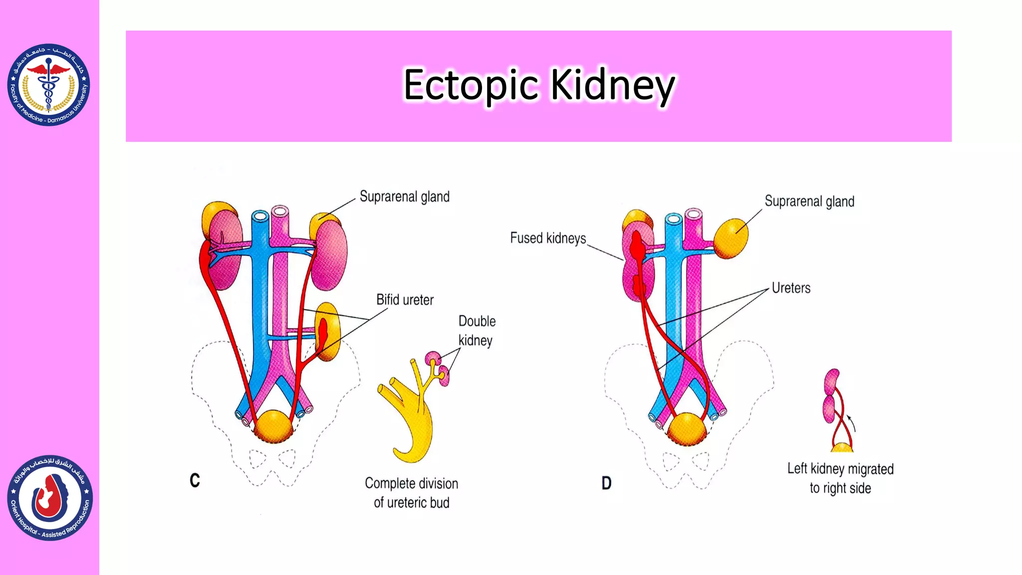 Urinary system anomalies | PDF