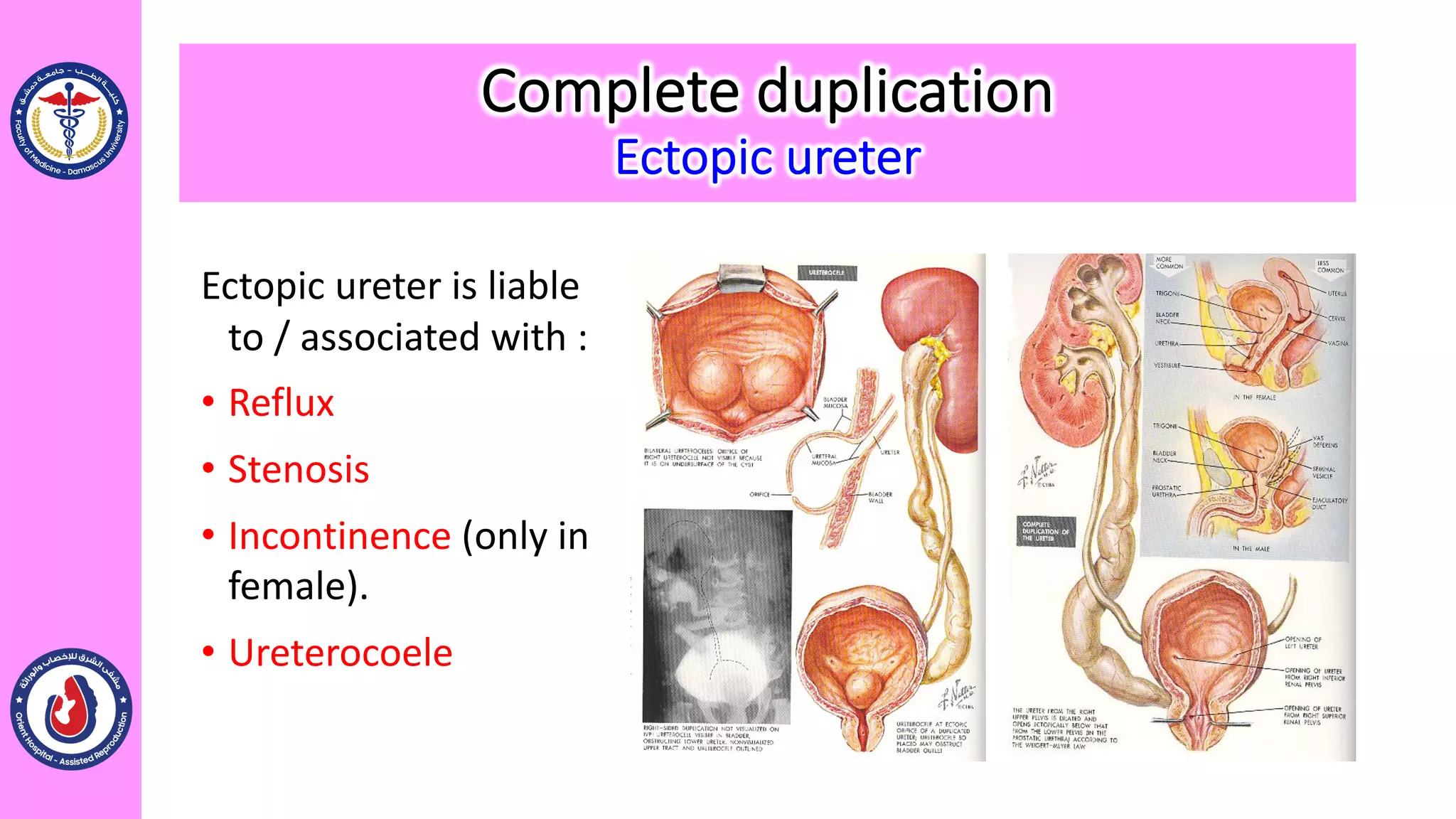 Urinary system anomalies | PDF