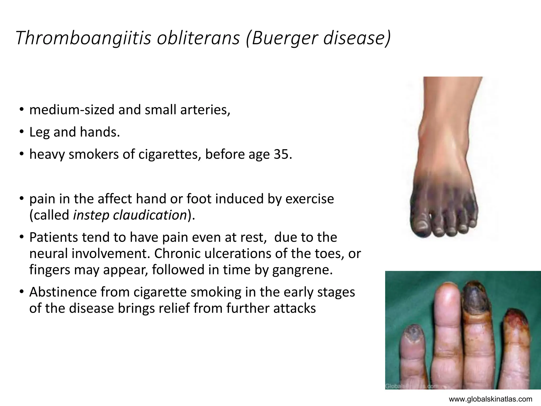 Vaskulitis/ Giant cell arteritis/ temporalis arteritis | PPT