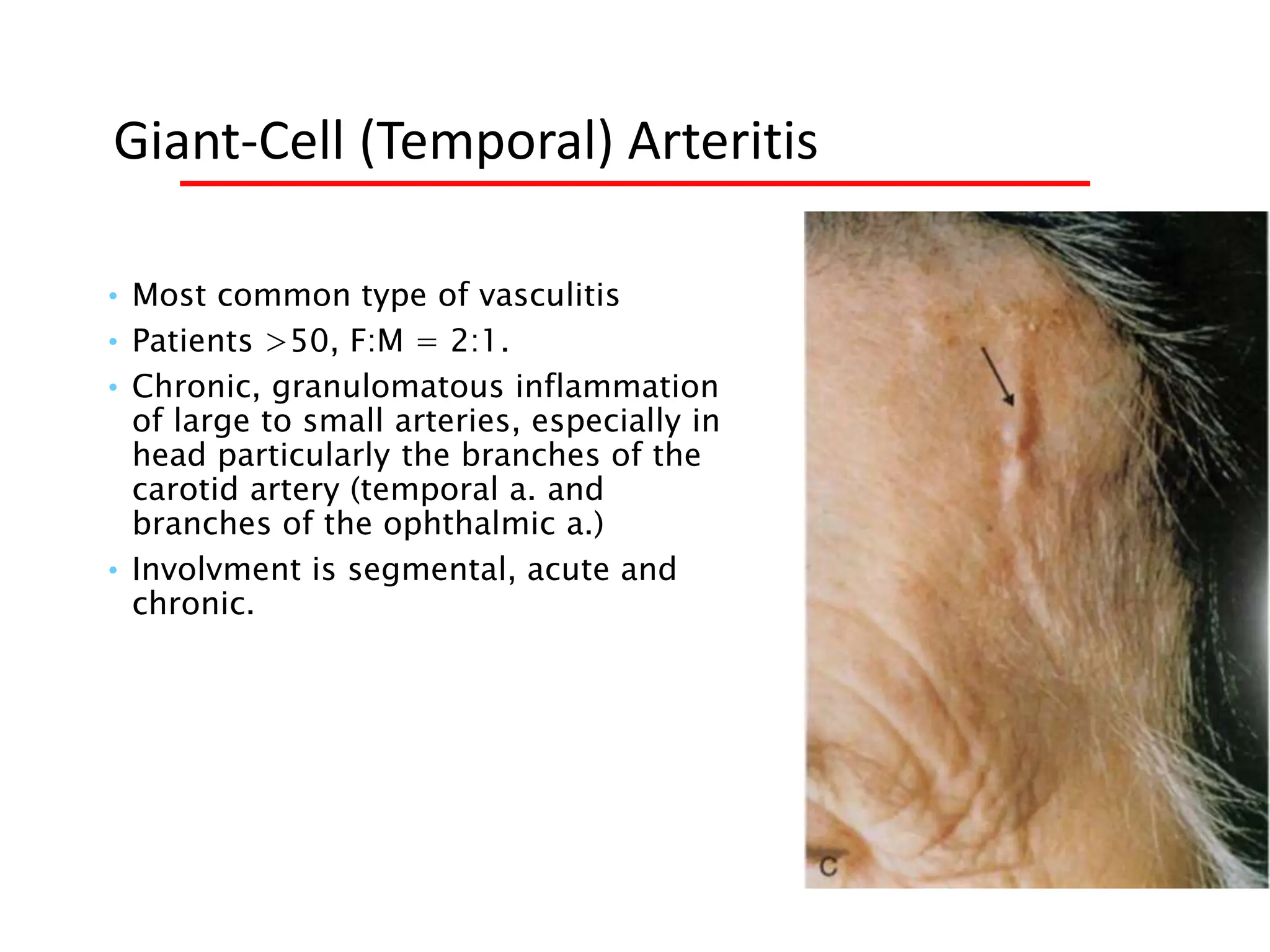 Vaskulitis/ Giant cell arteritis/ temporalis arteritis | PPT