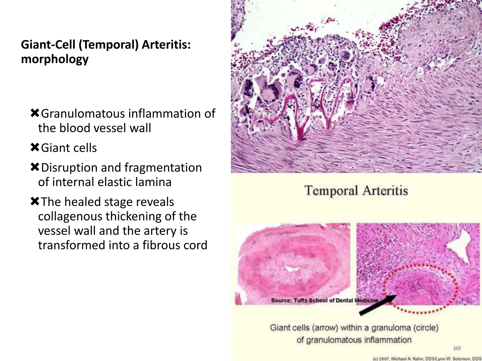 Vaskulitis/ Giant cell arteritis/ temporalis arteritis | PPT