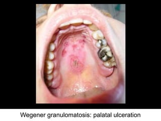 Vaskulitis/ Giant cell arteritis/ temporalis arteritis | PPT