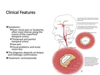 Vaskulitis/ Giant cell arteritis/ temporalis arteritis | PPT
