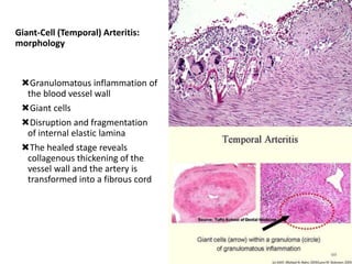 Vaskulitis/ Giant cell arteritis/ temporalis arteritis | PPT