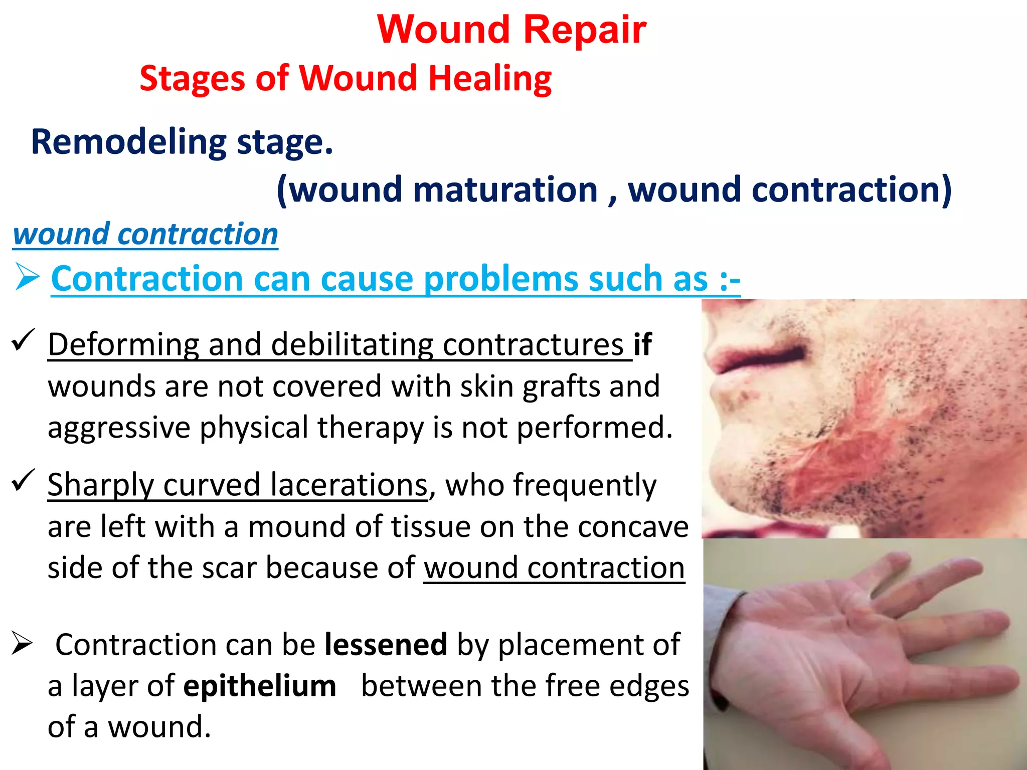 wound repair | PPTX