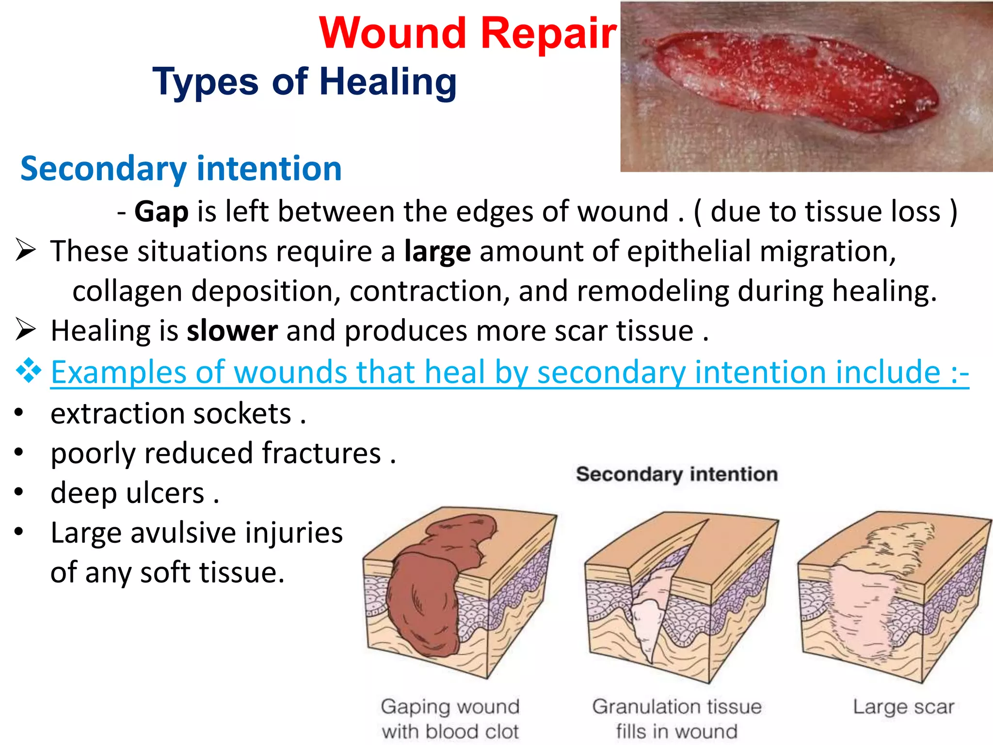wound repair | PPTX