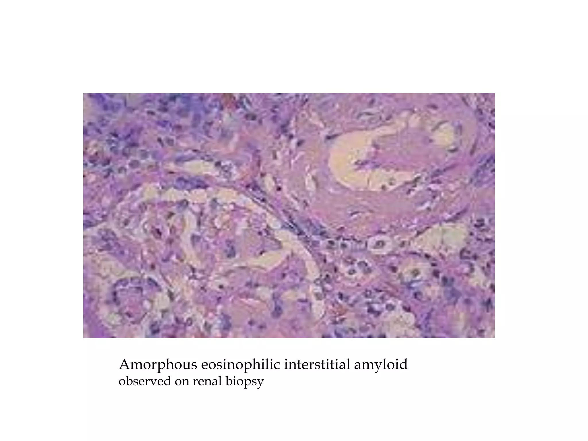 40. AMYLOIDOSIS.ppt | Free Download