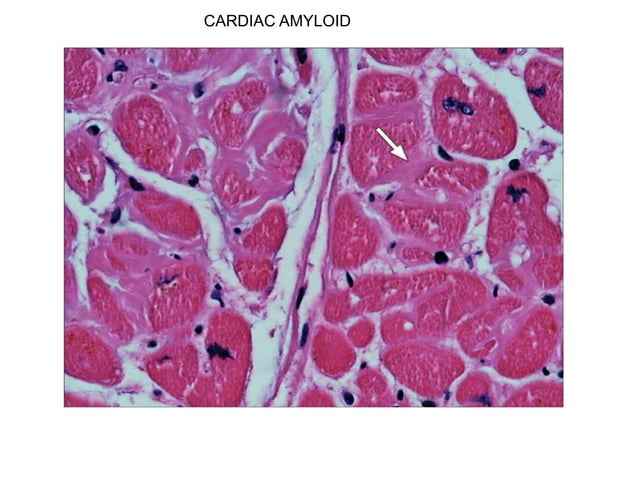 40. AMYLOIDOSIS.ppt | Free Download