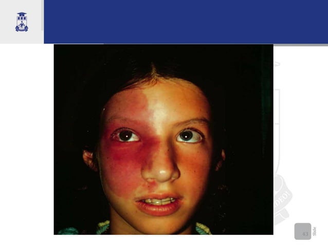 Genetic syndromes of children and developmental disorders | PDF