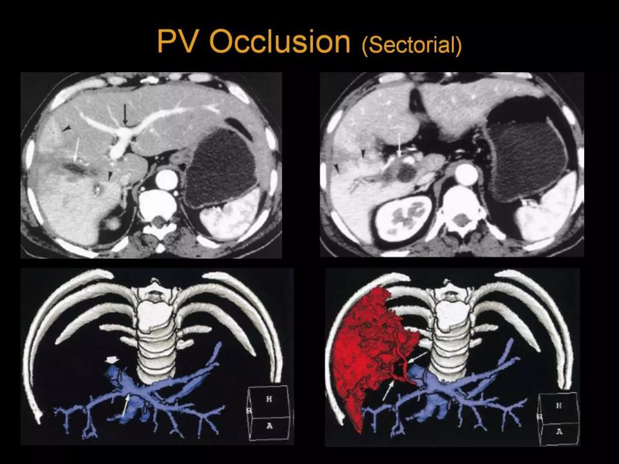 40-Dr Ahmed Esawy imaging oral board of liver part IV hepatic ...